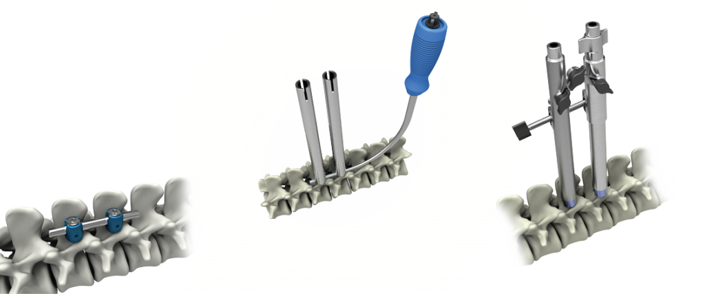 Spinal Fixation System | Inram Development & Design LTD